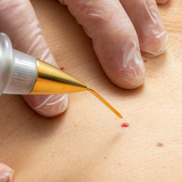 Skin Tag Removal – Dr. Shelly Hall, MD